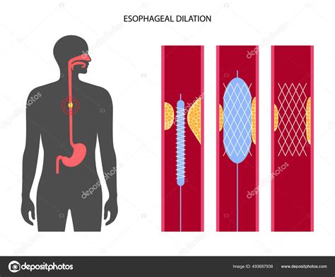 Cartoon Esophagus