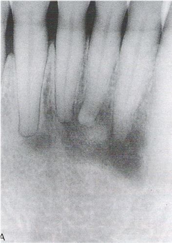 Oral Pathology Chapter Flashcards Quizlet