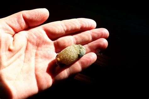 Gallstone Disease Cholelithiasis The Formation Of Stones Stones In