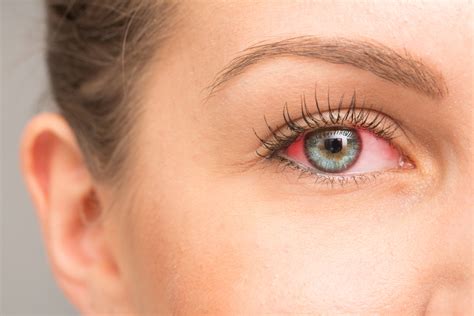 Common Eye Allergy Symptoms Speak To A Doctor Online SmartDocMD