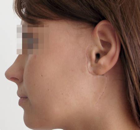 Parotid Gland After Surgery