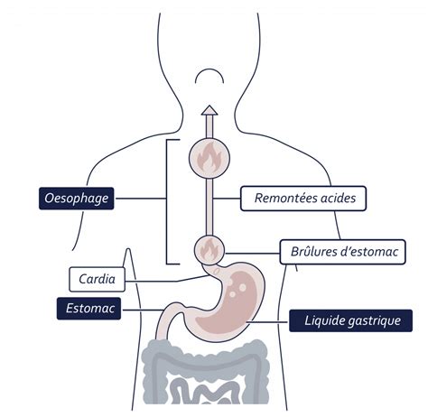Reflux gastro œsophagien RGO Laboratoires Grimberg