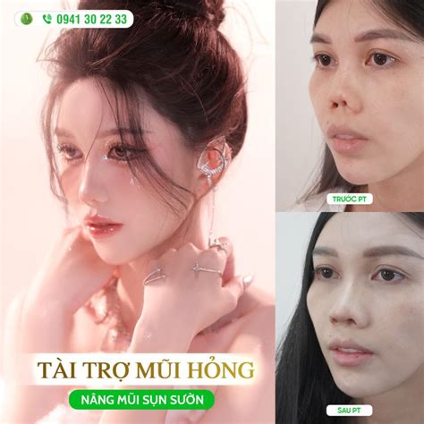 HOT TIKTOKER HUYỀN EM NHAN SẮC HOÀN HẢO SAU NÂNG MŨI