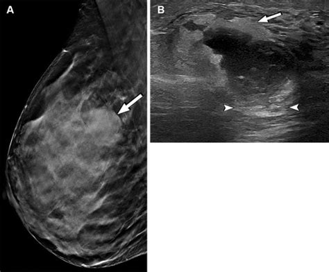 PHOTO GALLERY What Does Breast Cancer Look Like On 42 OFF
