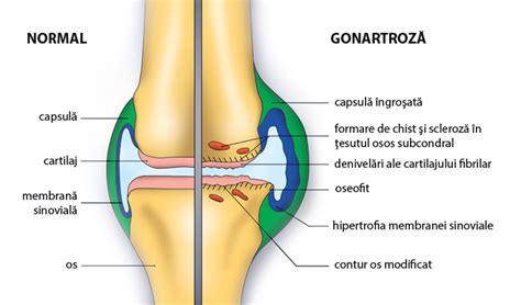Gonartroza Cauze Simptome Si Tratament Dr Andreea Lupu