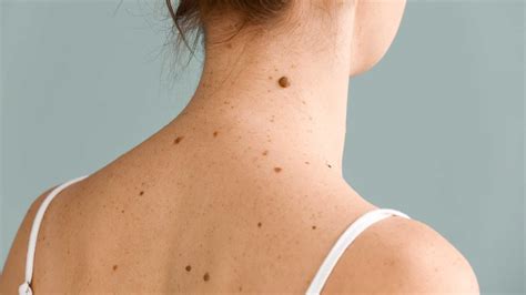 Conoce El ABCDE De Los Lunares Lima Derma