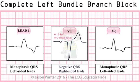 ECG Educator Blog Bundle Branch Blocks