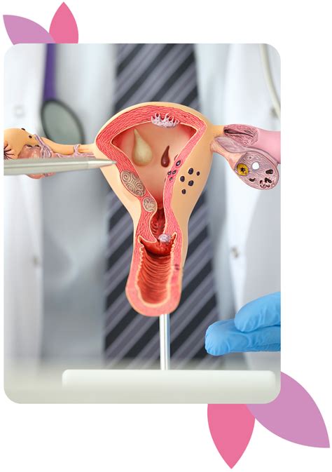 Miomatosis uterina Dra Fátima Cortés