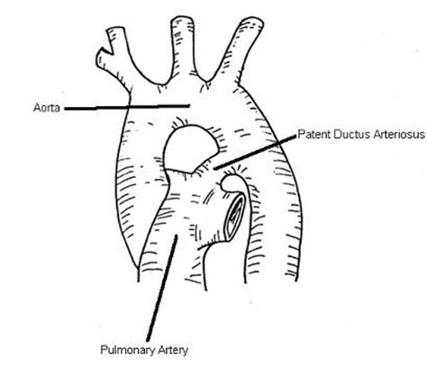 Patent Ductus Arteriosus PDA Healthengine Blog