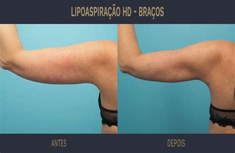 Lipo Nos Braços Fotos Antes E Depois Livros