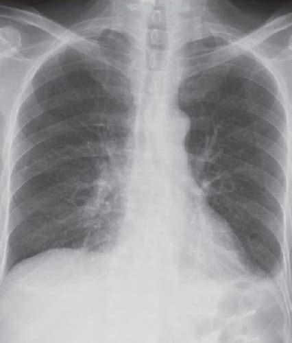 Pleural Diseases Flashcards Quizlet