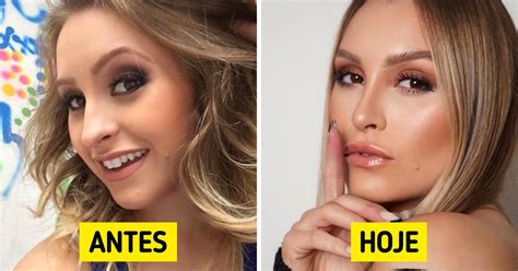 11 Famosos que já fizeram procedimentos estéticos e tiveram um
