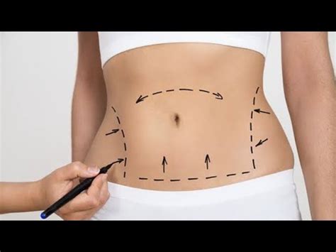 Abdominoplastia O que você precisa saber YouTube