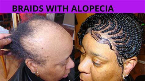 LACE FRONT BRAIDS WITH ALOPECIA BRAIDS WITH ALOPECIA YouTube