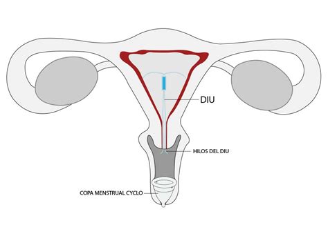 Intrusión monitor Dibuja una imagen puedo usar tampon con diu lo hizo