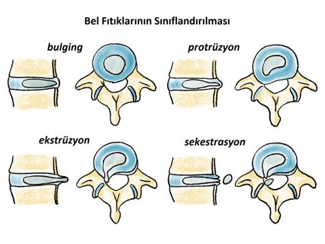 L5 S1 Bel Fıtığı Belirtileri ve Tedavisi L5 S1 Neresidir Doktor Fizik