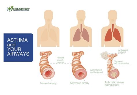 Asthmatic Lungs Biokineticist Andries Lodder Bio Me
