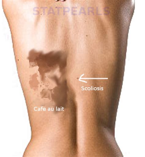 Figure McCune AlBright Image Courtesy S Bhimji MD StatPearls