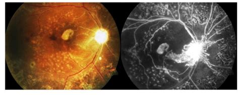 on detection of diabetic retinopathy via multiple instance learning