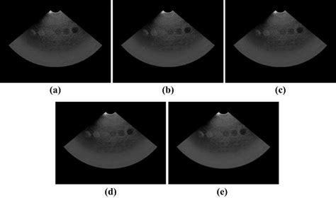 figure 4 from improvement of ultrasound image quality using non local means noise reduction