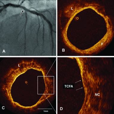 In Vivo Characterisation Of Coronary Atherosclerosis With Optical