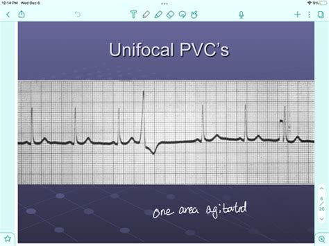 Ventricular Dysrhythmias Flashcards Quizlet