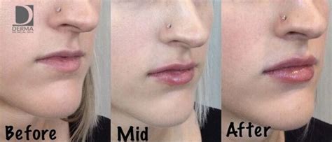 Lip Filler In Stages Lip Fillers Restylane Lyft Lips