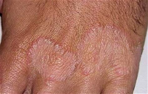 Hand Fungus Symptoms Causes Pictures And Treatment