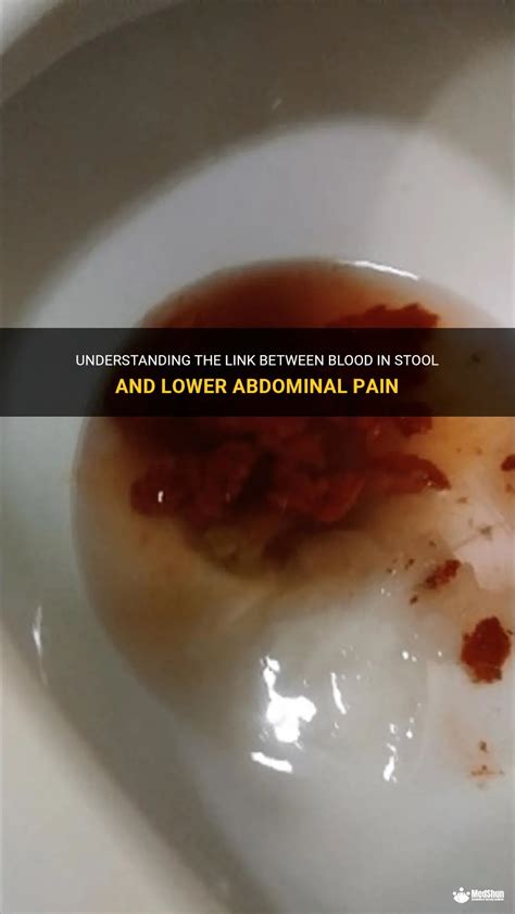 Understanding The Link Between Blood In Stool And Lower Abdominal Pain