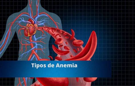 Conheça as causas e tipos da Anemia Blog NutriLifeCaps