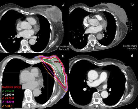 Frontiers Case Report Ultrahypofractionated Palliative Breast