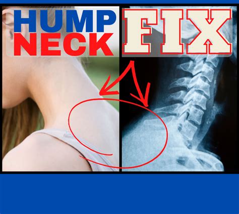 Neck Hump Fix Chiropractic On Eagle Dr Jon Saunders