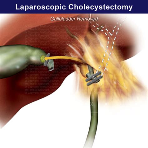 Removal Of Gallbladder During Laparoscopic Cholecystectomy