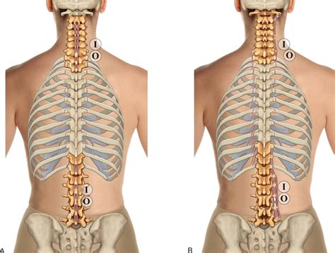 Muscles Of The Spine And Rib Cage Musculoskeletal Key