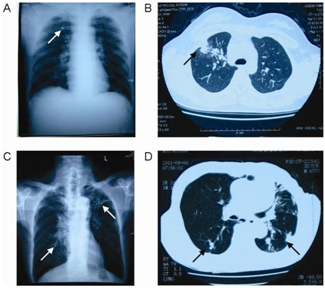 Radiographic Findings Of The Pulmonary Tuberculosis Patients Arrow