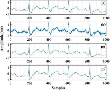 figure 6 from a new ecg denoising framework using generative adversarial network semantic scholar