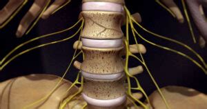 Herniated Disc S1 S2 Symptoms Treatment Dr Kevin Pauza The