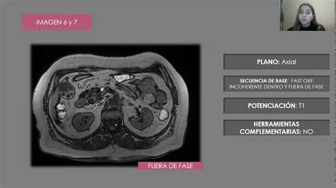 CASO ABDOMEN RESONANCIA MAGNETICA YouTube
