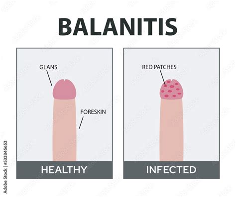 Candida Balanitis Vector Illustration Male Yeast Infection Stock