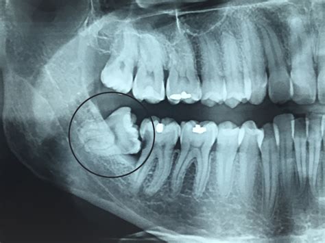 Dentes Do Siso Devo Extrair Dr Fernando Zugno Kulczynski