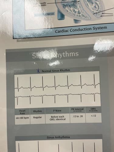 Ekg Flashcards Quizlet