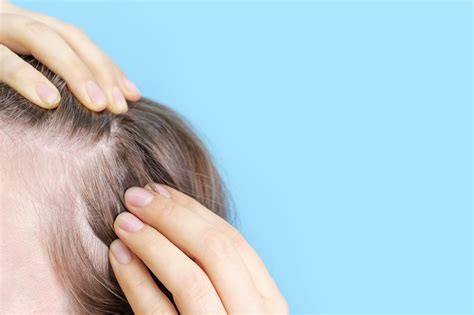Alopecia traumática causas síntomas y soluciones Salud Capilar