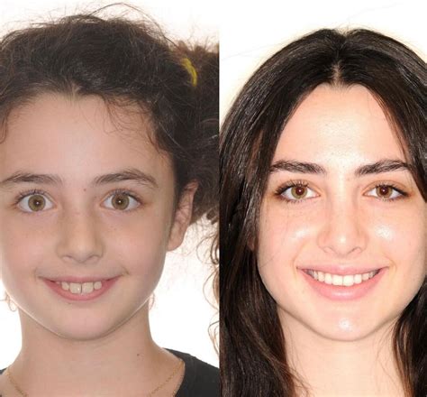 BEFORE AFTER The Power Of Orthodontics Lemchen Salzer Orthodontics