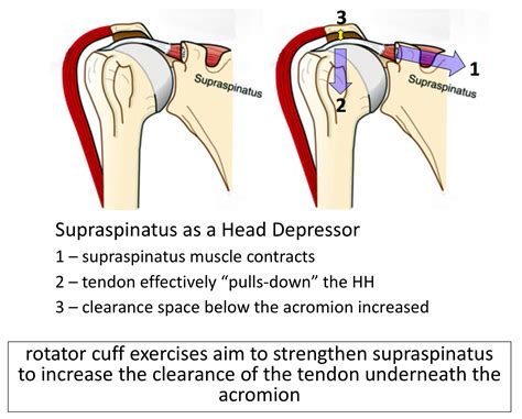 Rotator Cuff 3 Supraspinatus Tendonitis Treatment Cambridge Shoulder