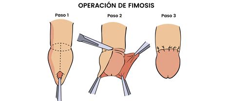 Operación de Fimosis Frenillo o Circuncisión Viamed Salud
