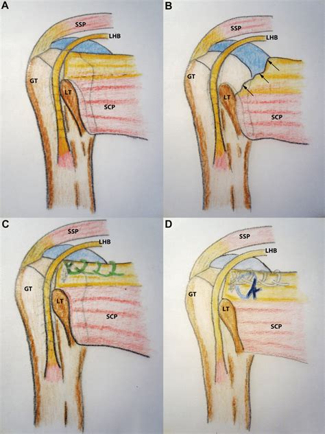 Right Shoulder In The Frontal View With The Subscapularis Tendon Scp