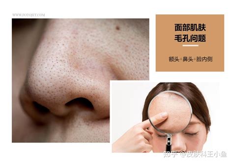 脸上油脂粒堵塞毛孔粗大怎么办皮肤科医生教你1招解决毛孔粗大的办法清除油脂粒收缩毛孔细腻肌肤一步到位 知乎