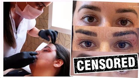 Revive tus ojos con hilos tensores Antes y después impresionantes