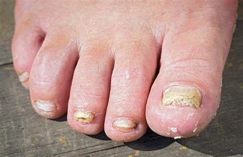 Hongos En La U As De Los Pies Moda Y Estilo