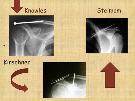 PPT FRACTURA DE CLAVÃ CULA PowerPoint Presentation free download